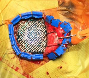 Cranioplasty | C.N.S. Neurosurgery