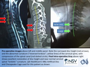 Restoration Reconstruction Cervical Spine | C.N.S. Neurosurgery