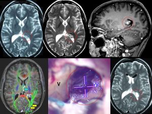 Cavernoma Surgery | Best Cavernoma Surgeon | Cavernous Malformation ...