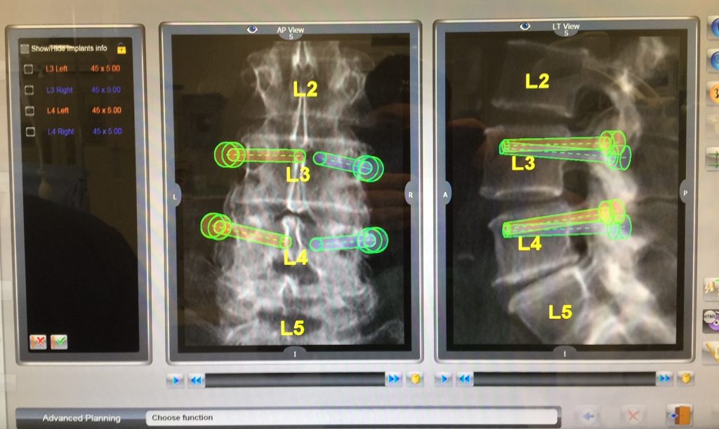 Artificial Disc Surgery | Lumbar Discectomy Australia | C.N.S. Neurosurgery