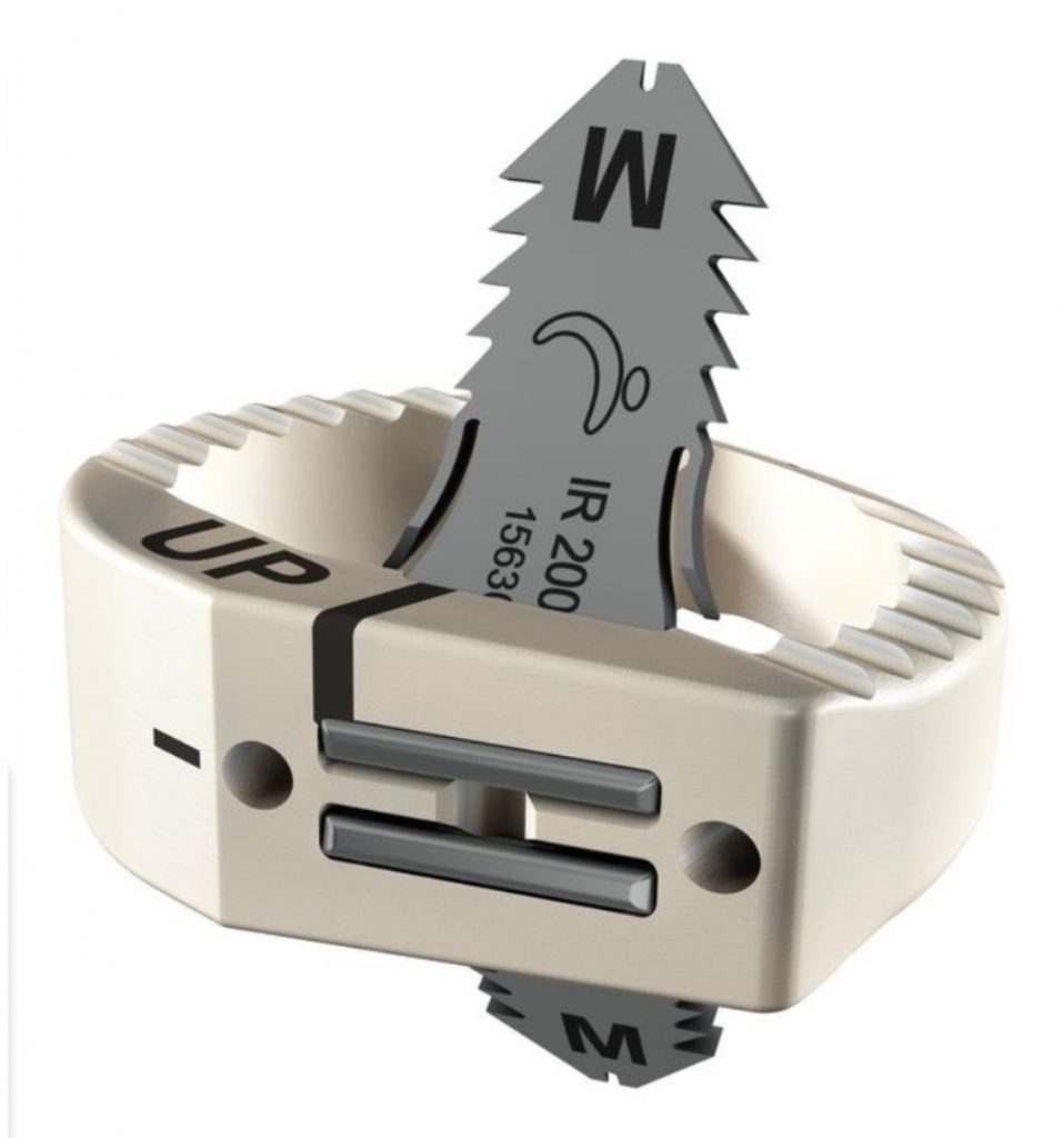 A minimally invasive anterior approach (ALIF) used to replace failed ...