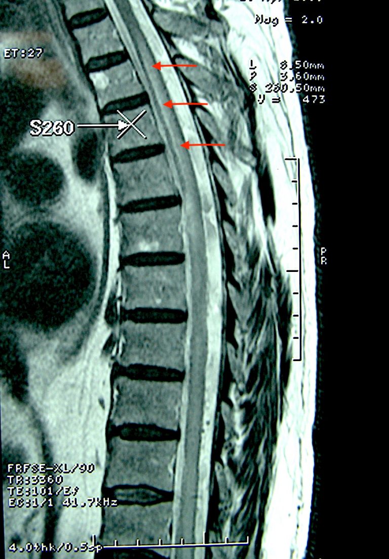 syrinx spinal cord | C.N.S. Neurosurgery