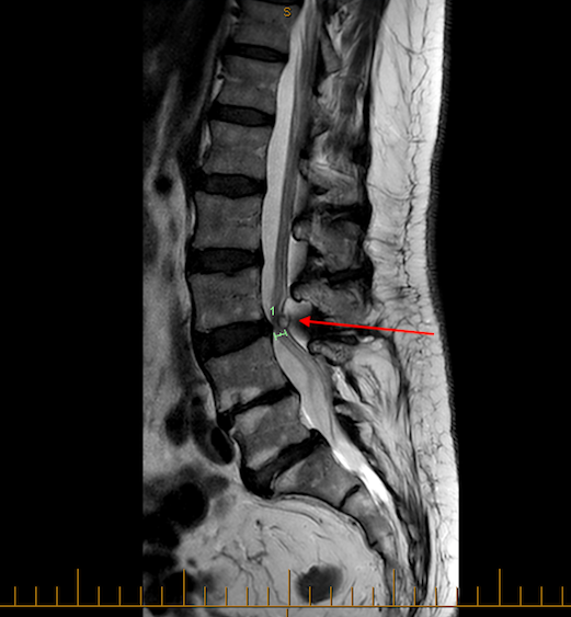 Facet Cyst C N S Neurosurgery Facet Cyst C N S Neurosurgery