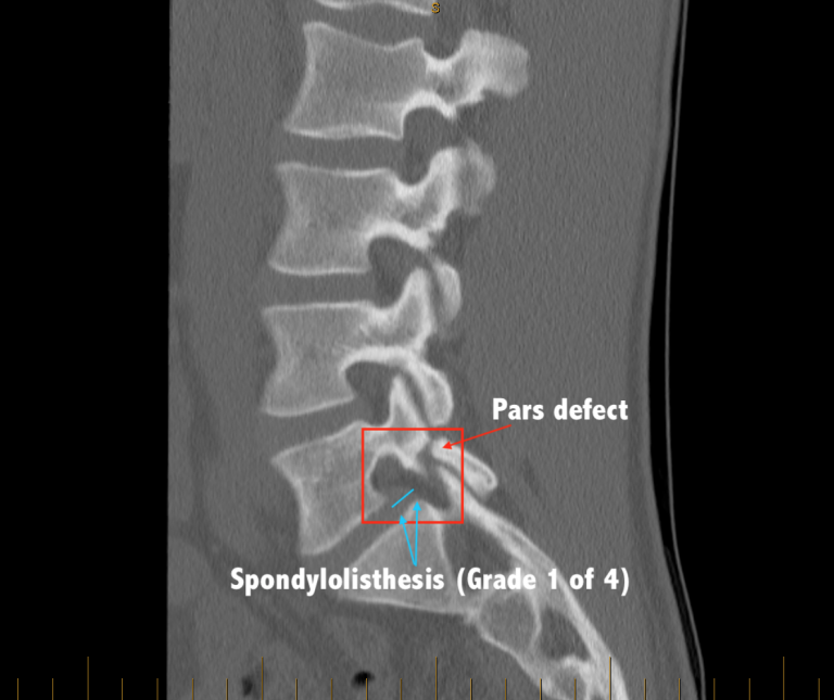 SPONDYLOLISTHESIS IMAGE | C.N.S. Neurosurgery