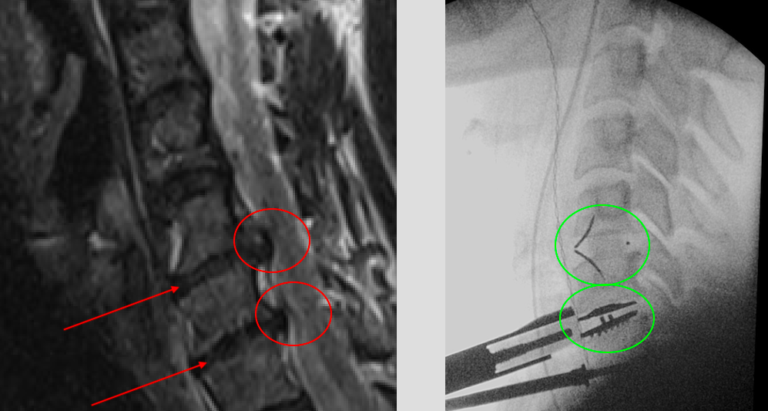 “Hybrid” anterior cervical and lumbar reconstructions – spinal ...