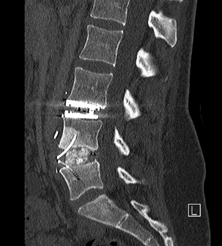 A wonderful set of prosthetics available for my spinal reconstruction ...