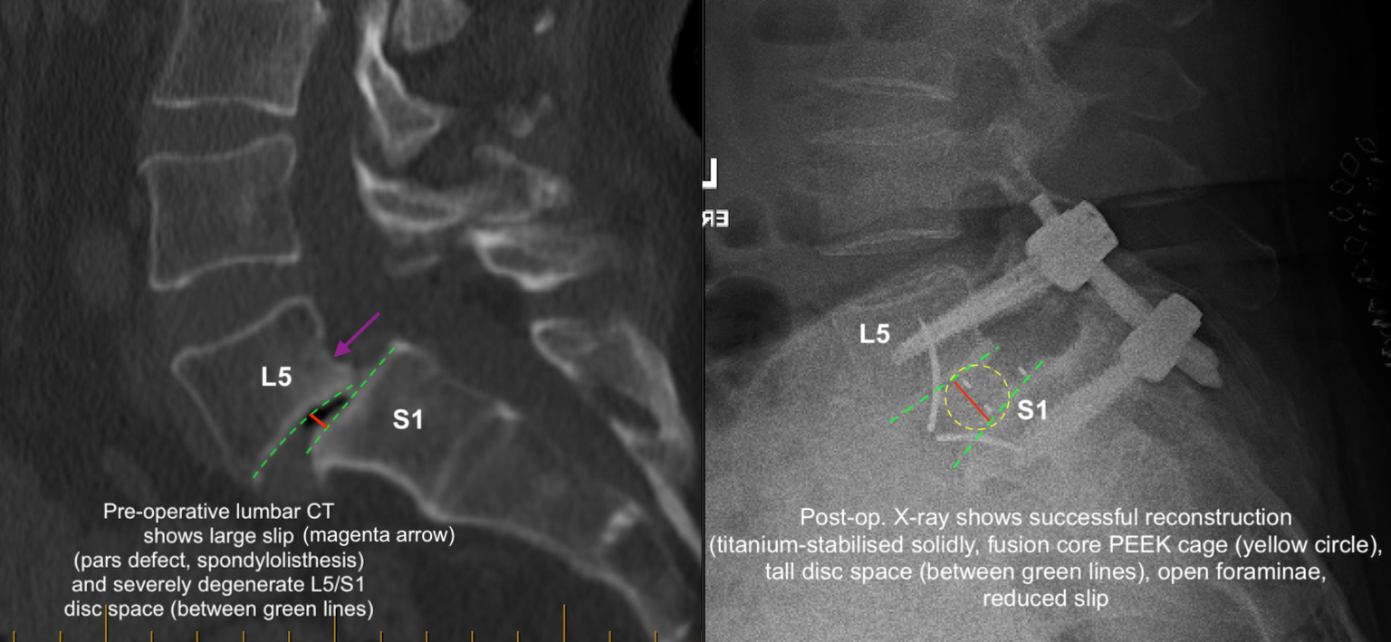 Artificial Disc Surgery | Lumbar Discectomy Australia | C.N.S. Neurosurgery