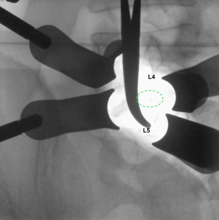 “Lumbarised S1” – The transitional (potentially mobile) lumbosacral ...