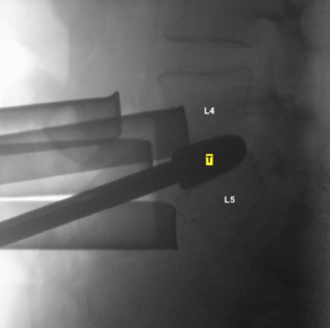 “Lumbarised S1” – The transitional (potentially mobile) lumbosacral ...