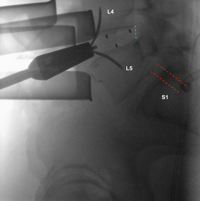 “Lumbarised S1” – The transitional (potentially mobile) lumbosacral ...
