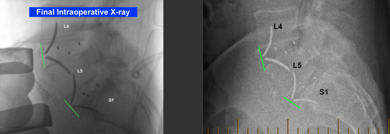 “Lumbarised S1” – The transitional (potentially mobile) lumbosacral ...