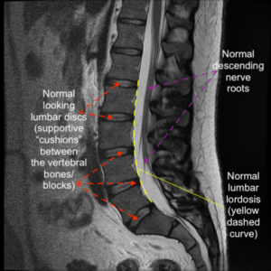 Normal versus abnormal lumbar anatomy | C.N.S. Neurosurgery
