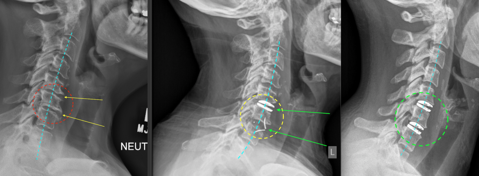Anterior cervical spinal reconstruction – cutting edge “hybrids” and ...