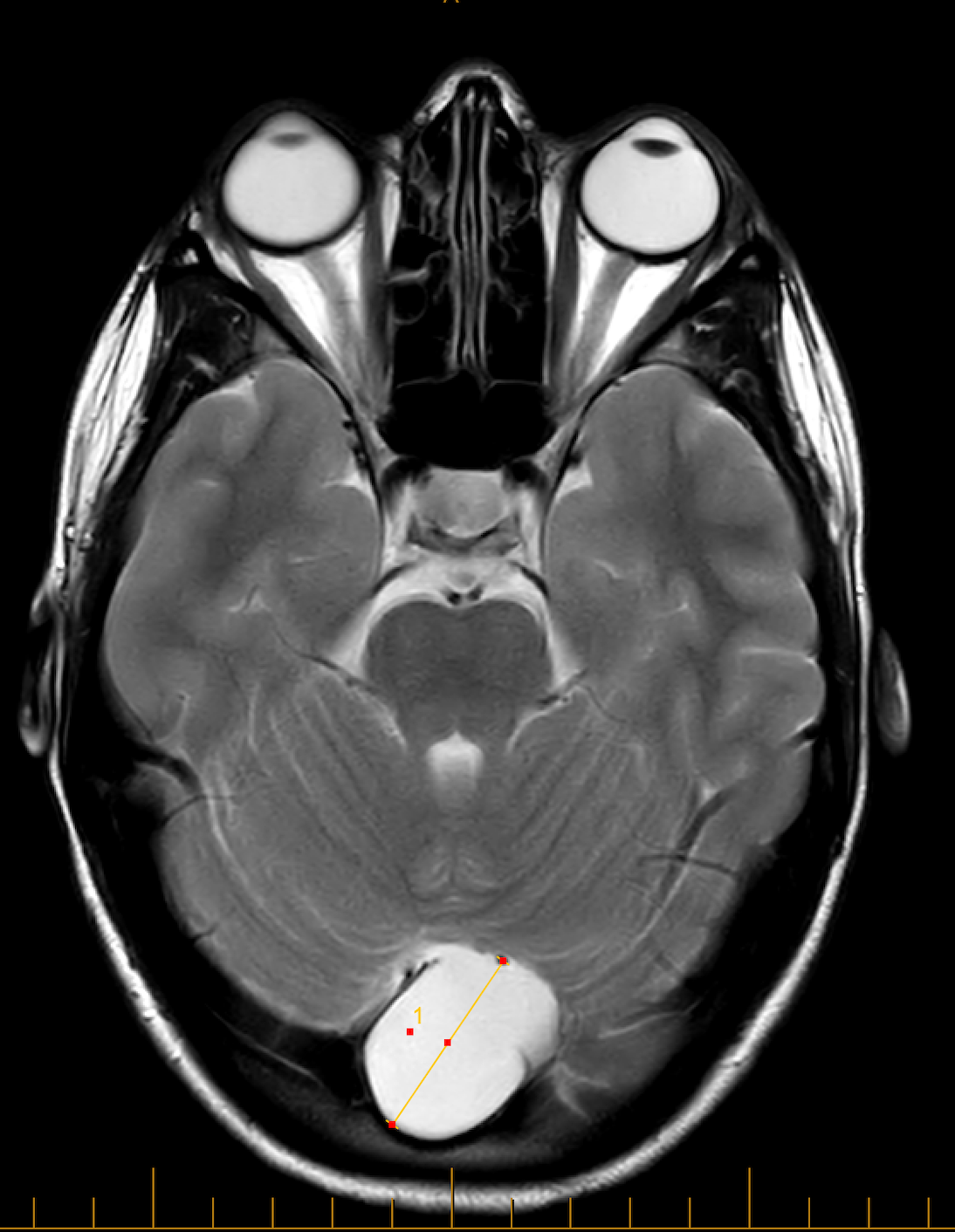 Arachnoid Cyst C N S Neurosurgery