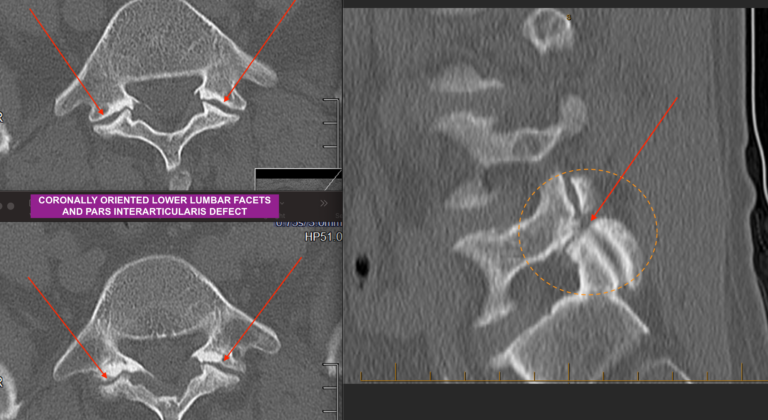 Orientation of your lower lumbar joints and the implication for back ...