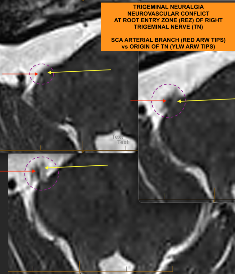 Trigeminal Neuralgia MVD Neuro Expert | C.N.S. Neurosurgery
