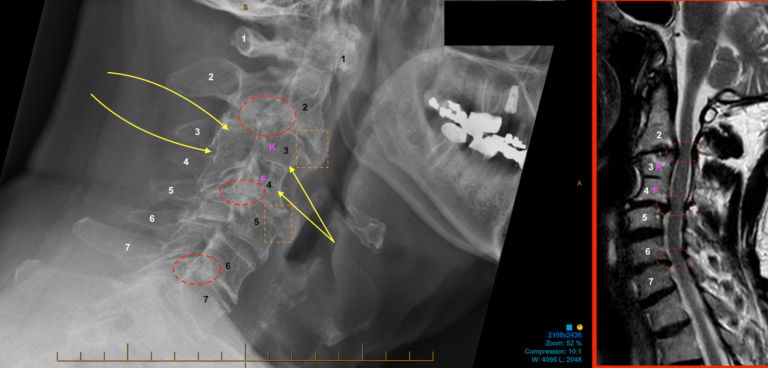 Klippel-Feil Syndrome. Congenital fusion. Cervical spinal cord ...