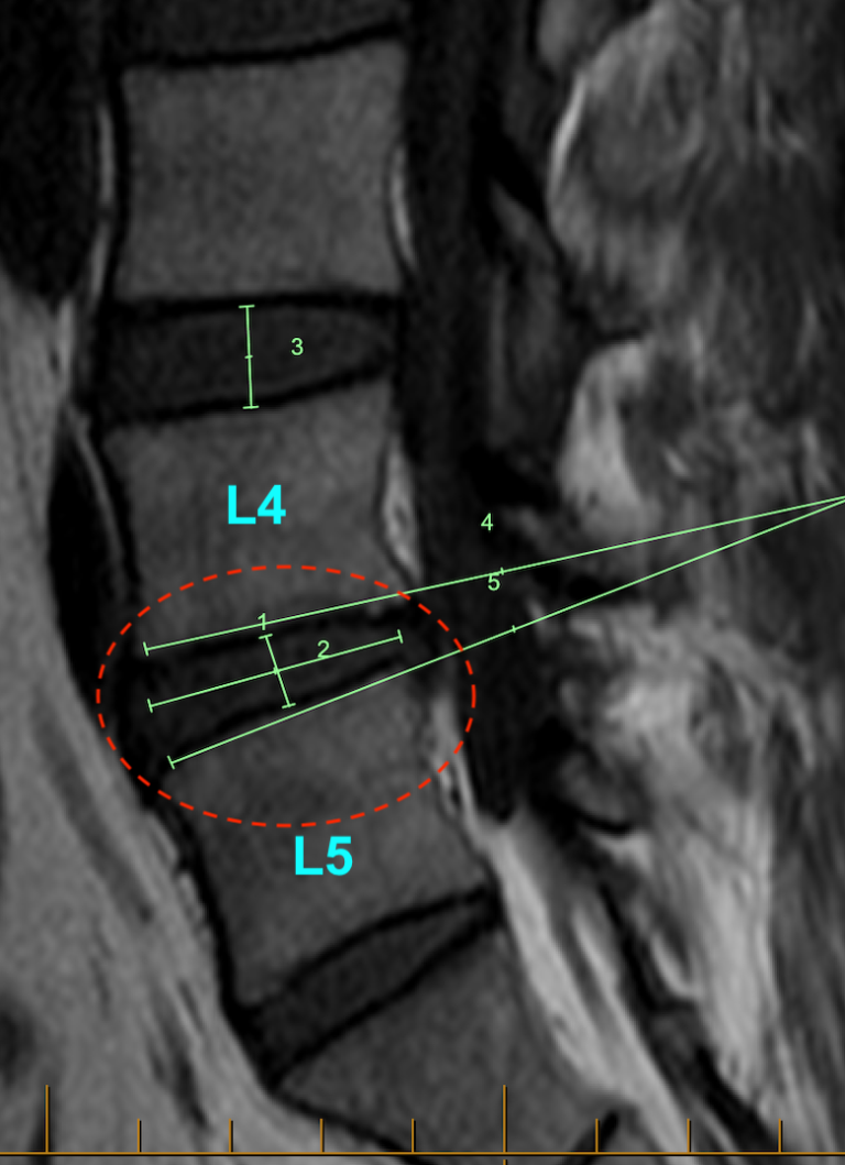 1-, 2-, & 3-level anterior lumbar spinal reconstructions: Beautiful ...
