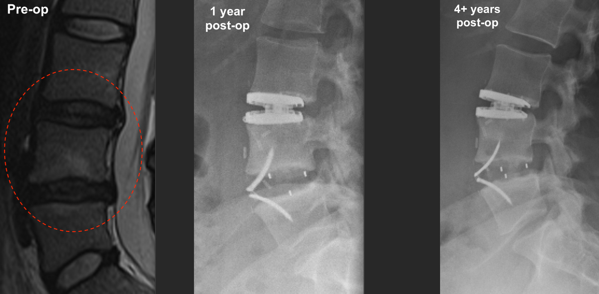 Radiological follow-up of some of my anterior lumbar prosthetic ...