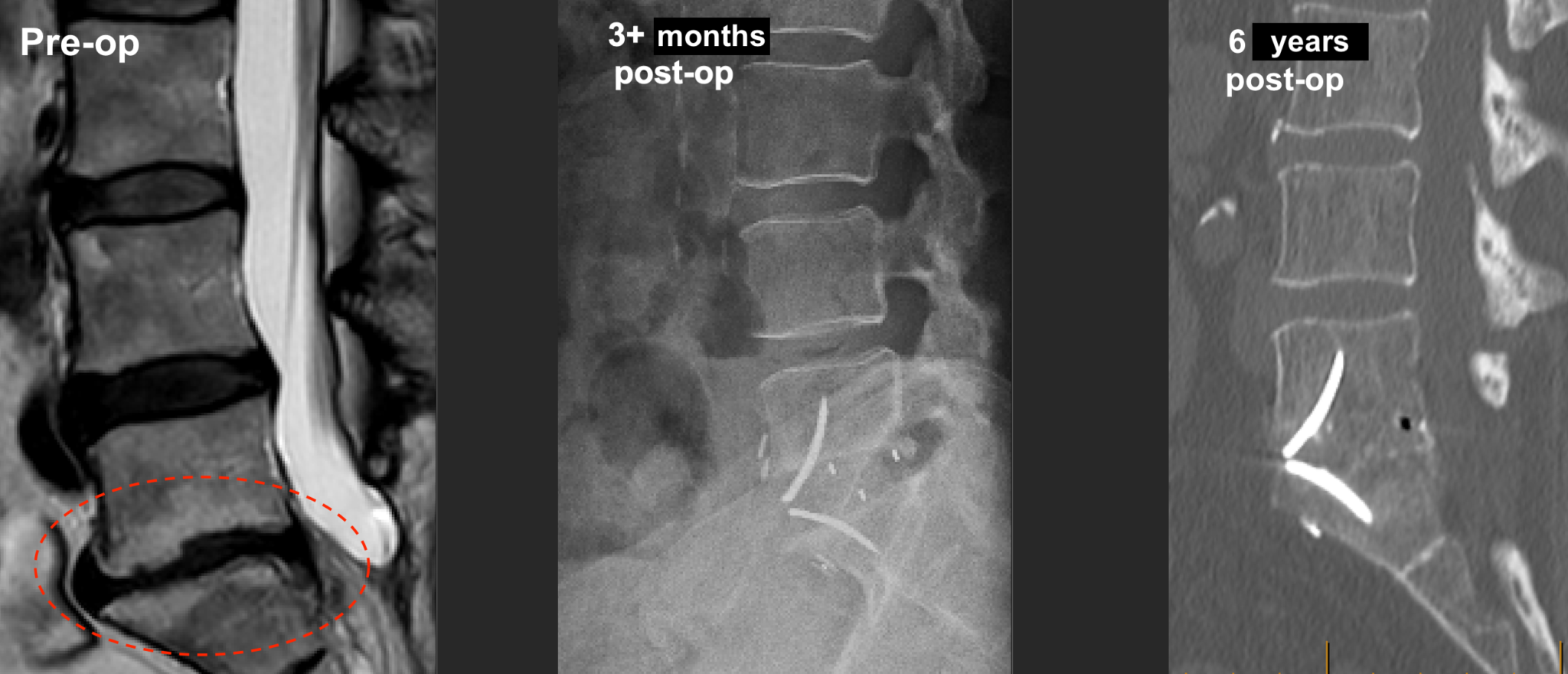 Radiological follow-up of some of my anterior lumbar prosthetic ...