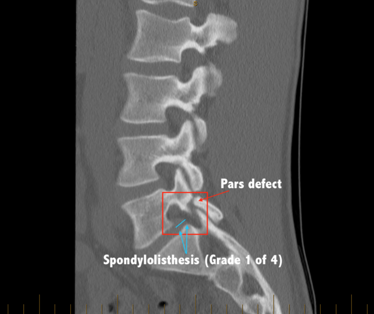 “360-degree” (“front-back”) Surgical Reconstruction of “Isthmic” and ...