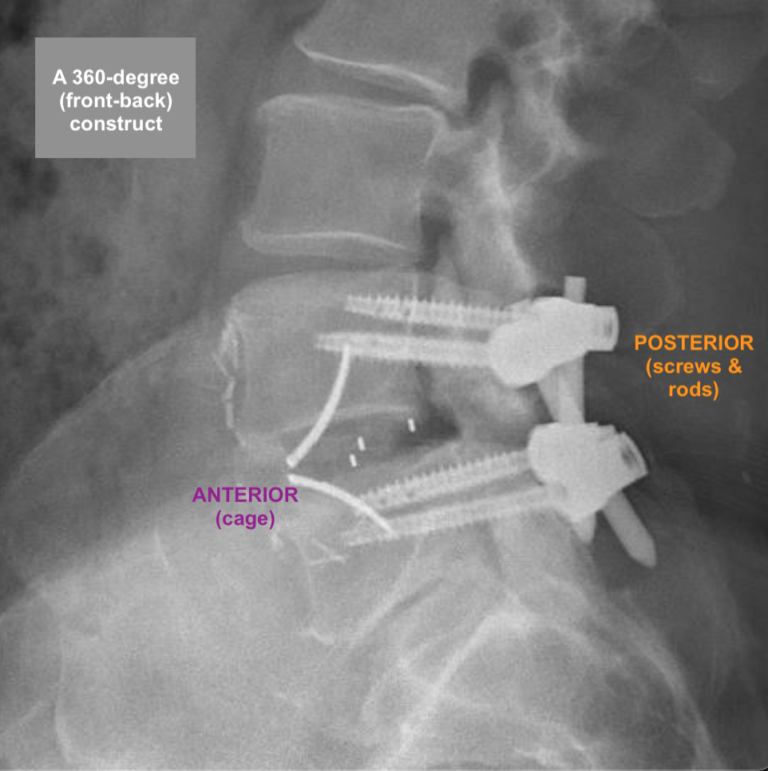 “360-degree” (“front-back”) Surgical Reconstruction of “Isthmic” and ...