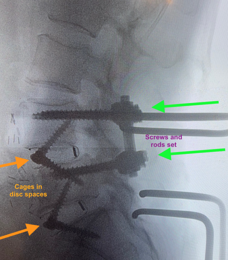 “360-degree” (“front-back”) Surgical Reconstruction of “Isthmic” and ...